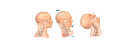 Lesión de latigazo cervical - Dr. Esteban Castro - Ortopedia y ...