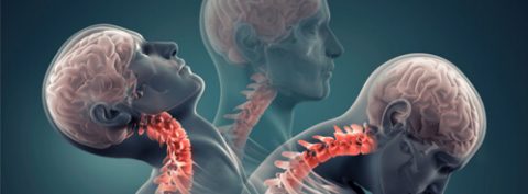 Lesión de latigazo cervical - Dr. Esteban Castro - Ortopedia y ...